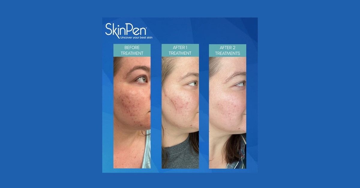 SkinPen Microneedling | Services | New You Aesthetics and Wellness